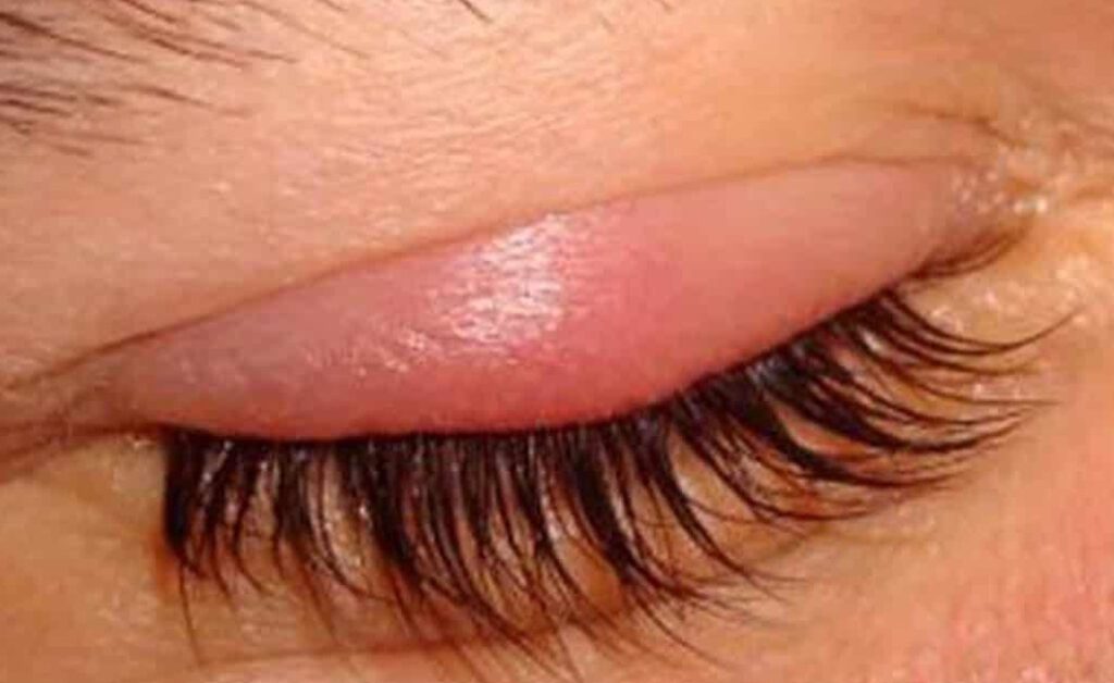 Stye | Orange County Children's Eye Doctor | Dr. Golareh Fazilat