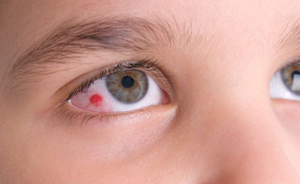 Red Eyes | Orange County Children's Eye Doctor | Dr. Golareh Fazilat